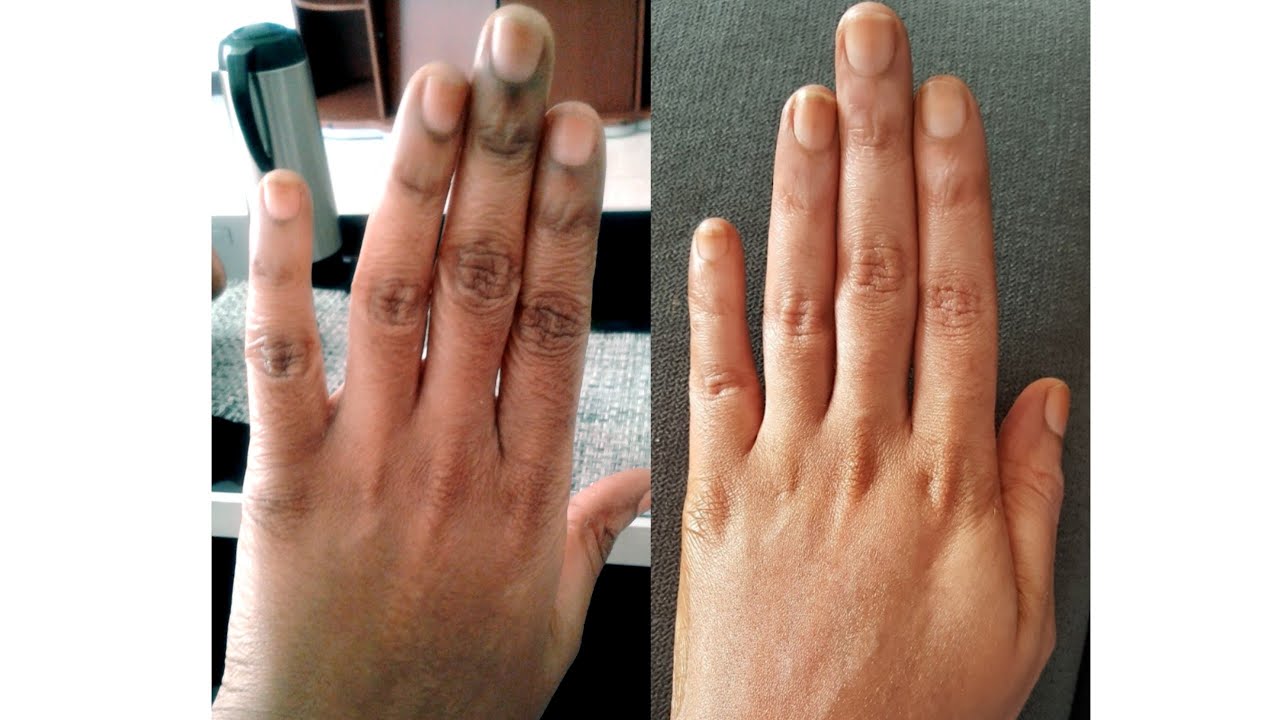 PART 2. 3DAYS DARK KNUCKLE TREATMENT 100%GUARANTEED FLAWLESS KNUCKLES ...