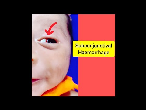 Subconjunctival Haemorrhage Of Newborn.(Blood In Eye) - YouTube