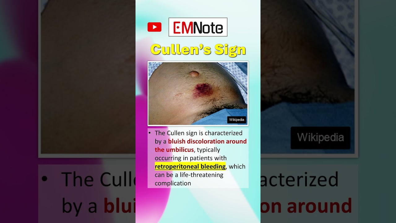 Cullens Sign Cullen Sign | Radiology Reference Article
