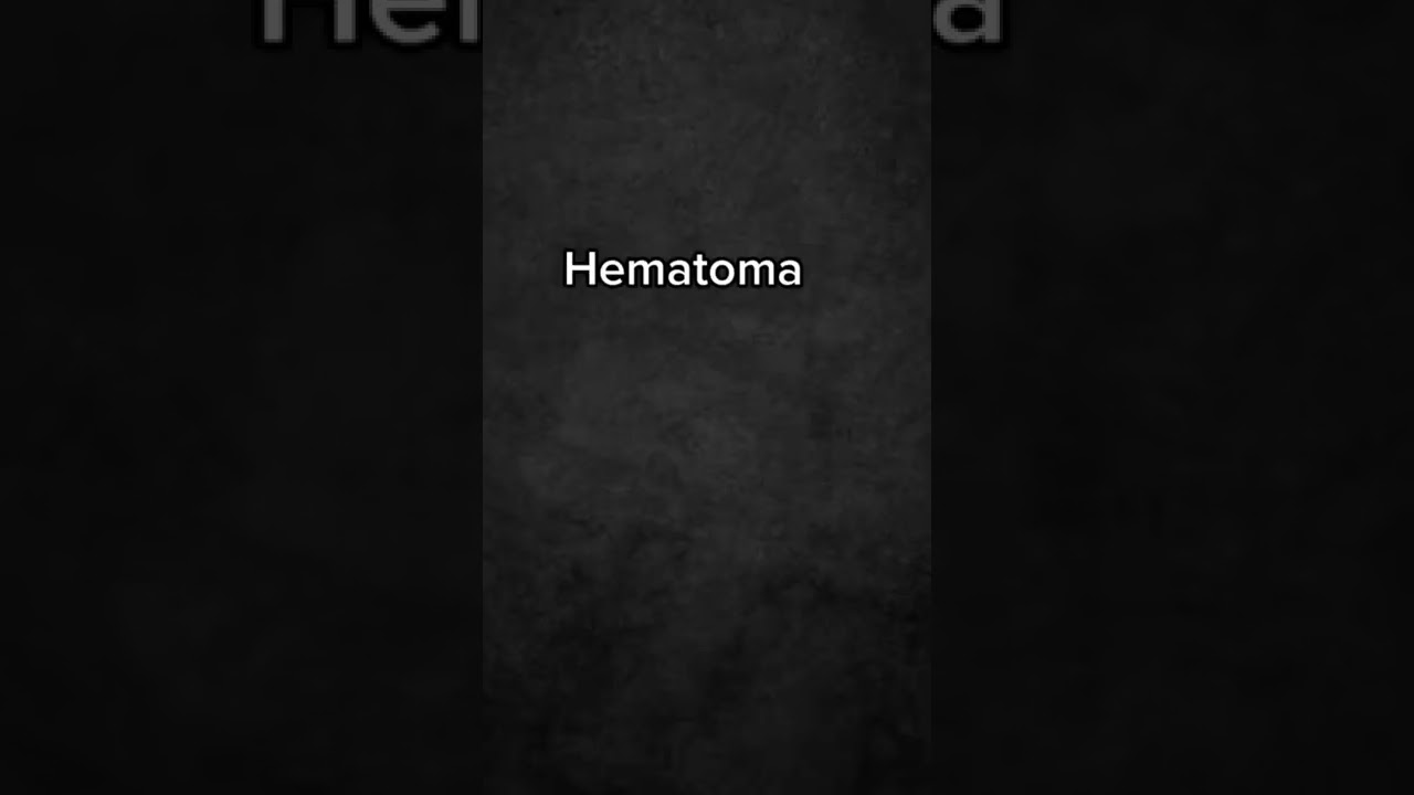 Diferença Entre Hematoma E Equimose - BRAINCP Diferença Entre Hematoma E Equimose - BRAINCP