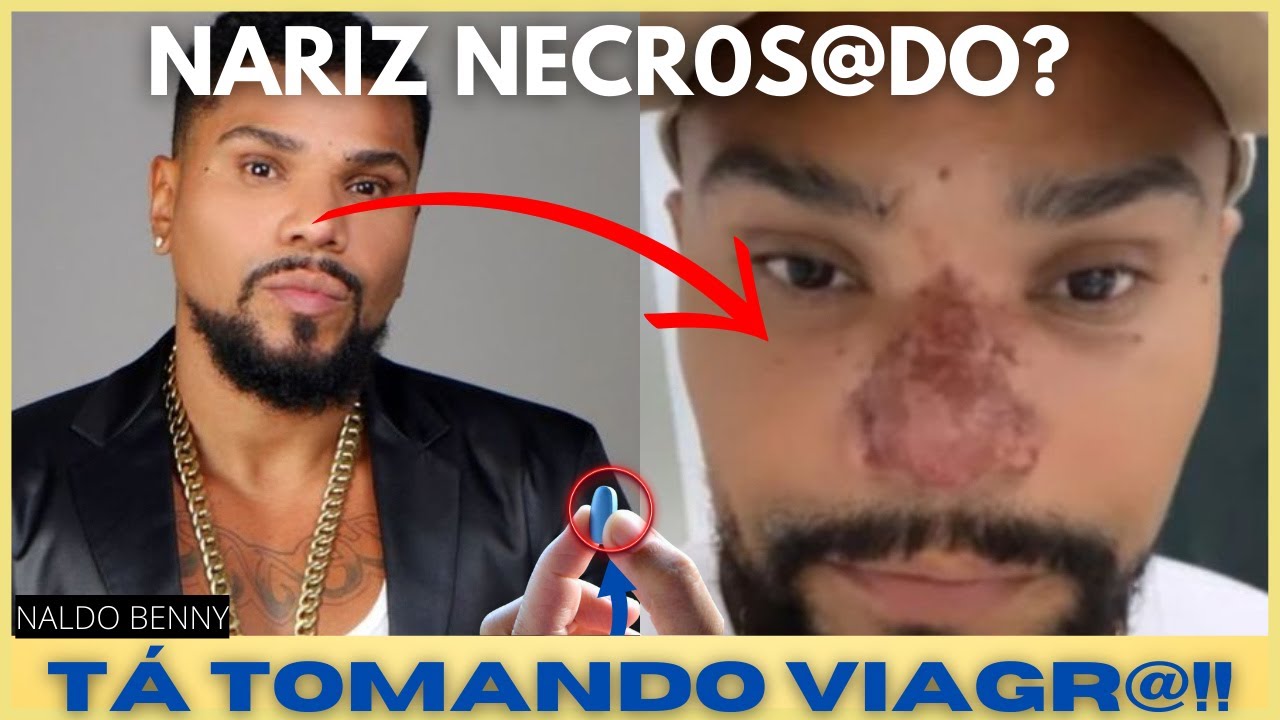 ⚠️NALDO MOSTRA DETALHES DO TRATAMENTO DEPOIS DE PRINCÍPIO DE NECROSE NO ...