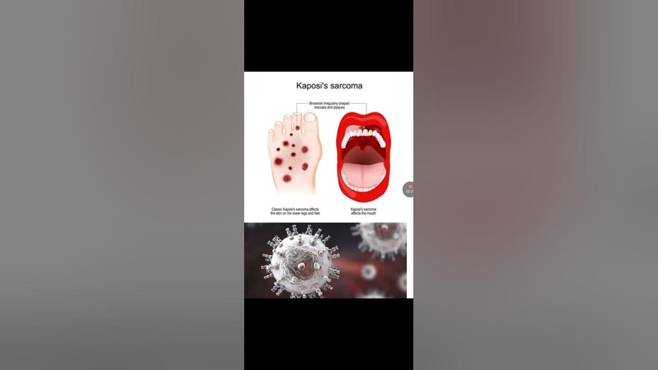 Kaposi Sarcoma Youtube