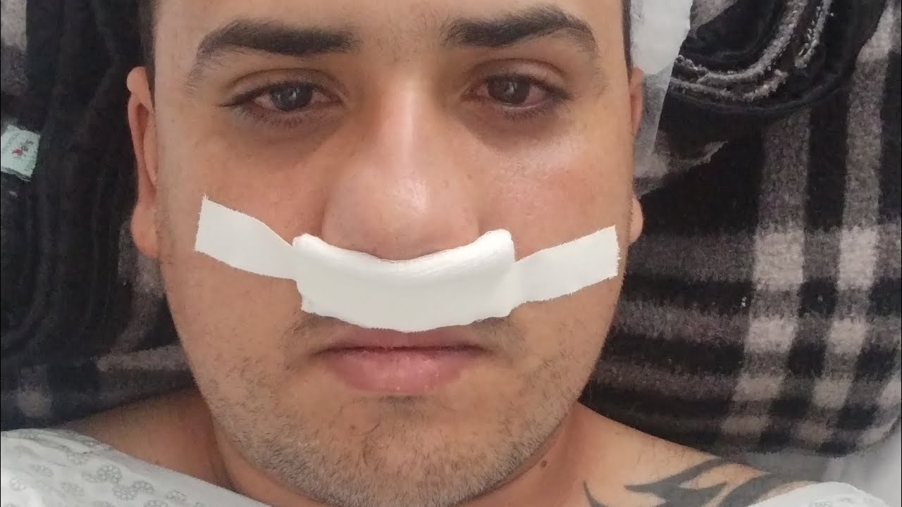 septoplastia turbinectomia sinusectomia pós operatório - YouTube