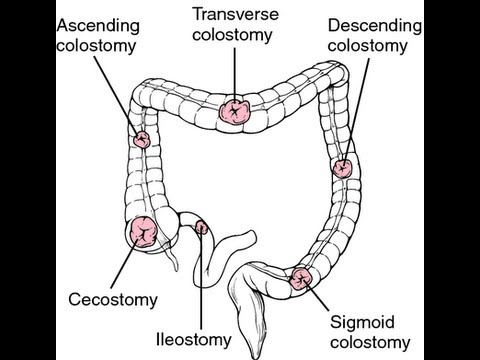 My history with Crohn's disease / Ulcerative Colitis preceding my ...