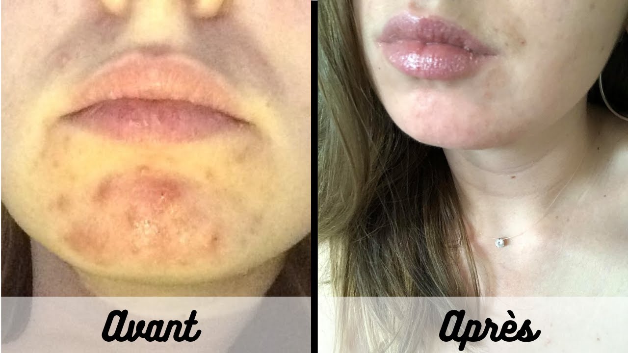 ROACCUTANE/PROCUTA/CURACNE : Mon expérience - YouTube