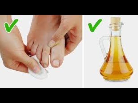 How To Fix Ingrown Toenails At Home | #STEPAhead - YouTube