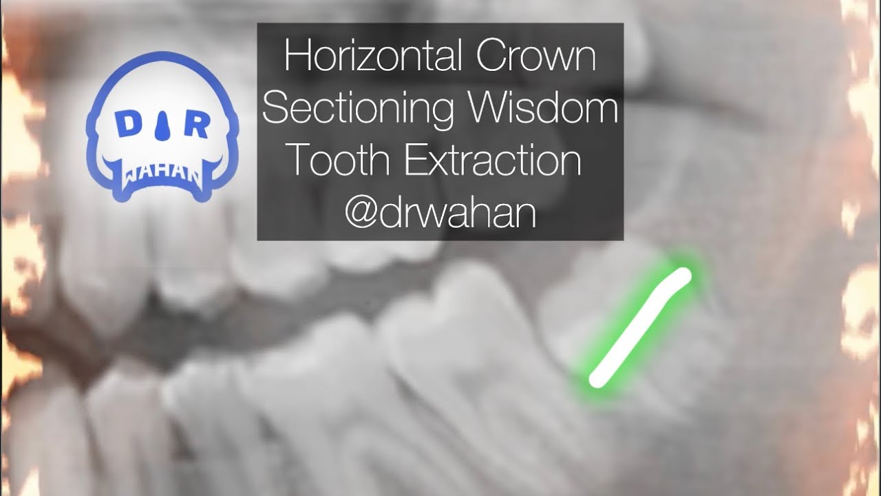 Horizontal Crown Sectioning for Wisdom Tooth Removal with Voiceover ...
