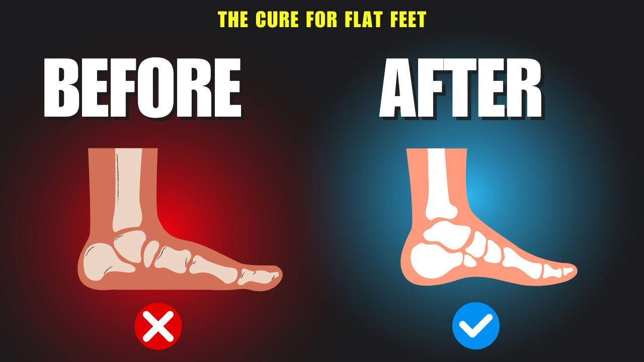 How to fix flat feet with simple exercises - YouTube