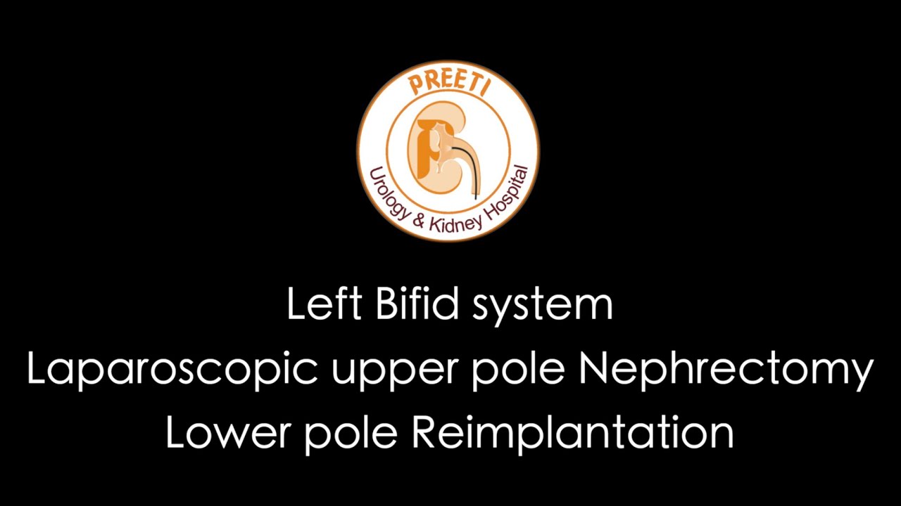 Left Bifid system Laparoscopic upper pole Nephrectomy Lower pole Ureter ...