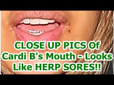 CLOSE UP PICS Of Cardi B's Mouth - Looks Like HERP SORES!! - YouTube