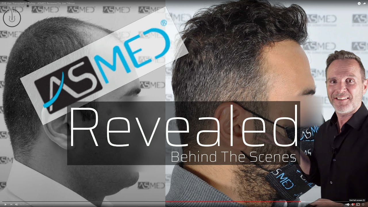 FUE Hair Transplant in Turkey - ASMED Reviewed by Joe Tillman - YouTube