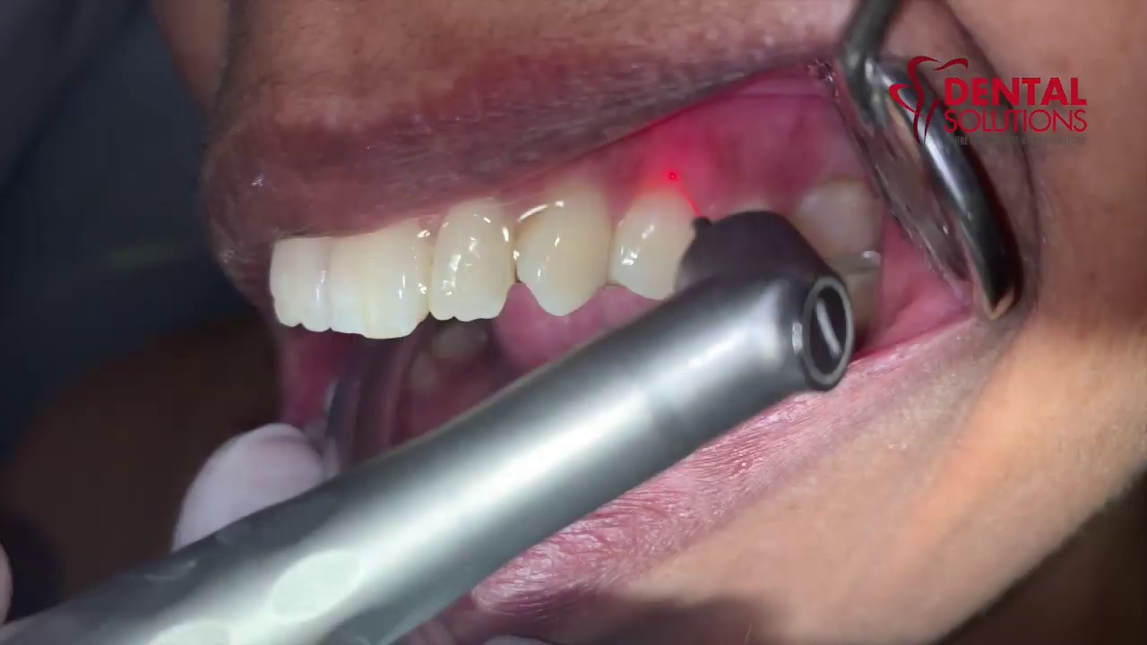 Contactless laser cavity filling using Er-Yag laser - Dental Solutions ...