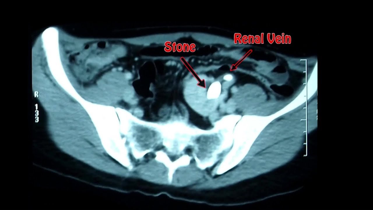 Laparoscopic Pyelolithotomy for Huge Stone of Left Ectopic Malrotated ...