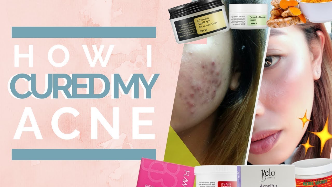 How I Cured My Acne + My Acne Story (Philippines) | Ochi Bernadas - YouTube
