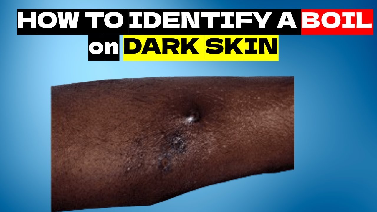Boils | How to identify a Boil on Dark Skin | Boils on Dark Skin Tone ...