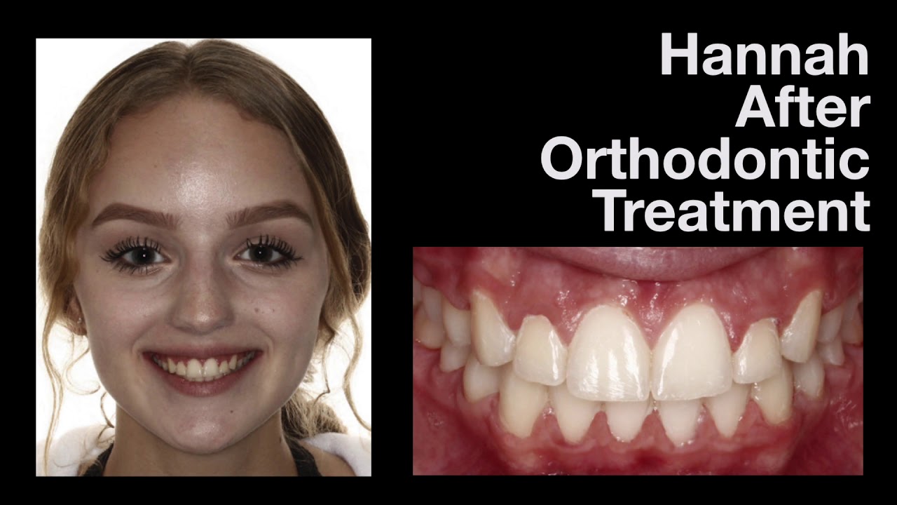 Hannah's New Smile! - YouTube