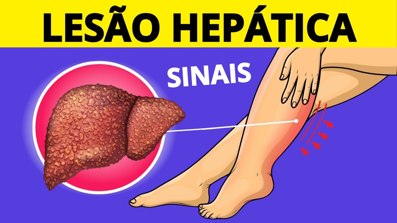 Sintomas de Lesão Hepática: 14 Principais Sinais de Doença no Fígado ...