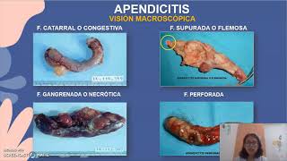 Histología de la Apendicitis aguda | Doovi