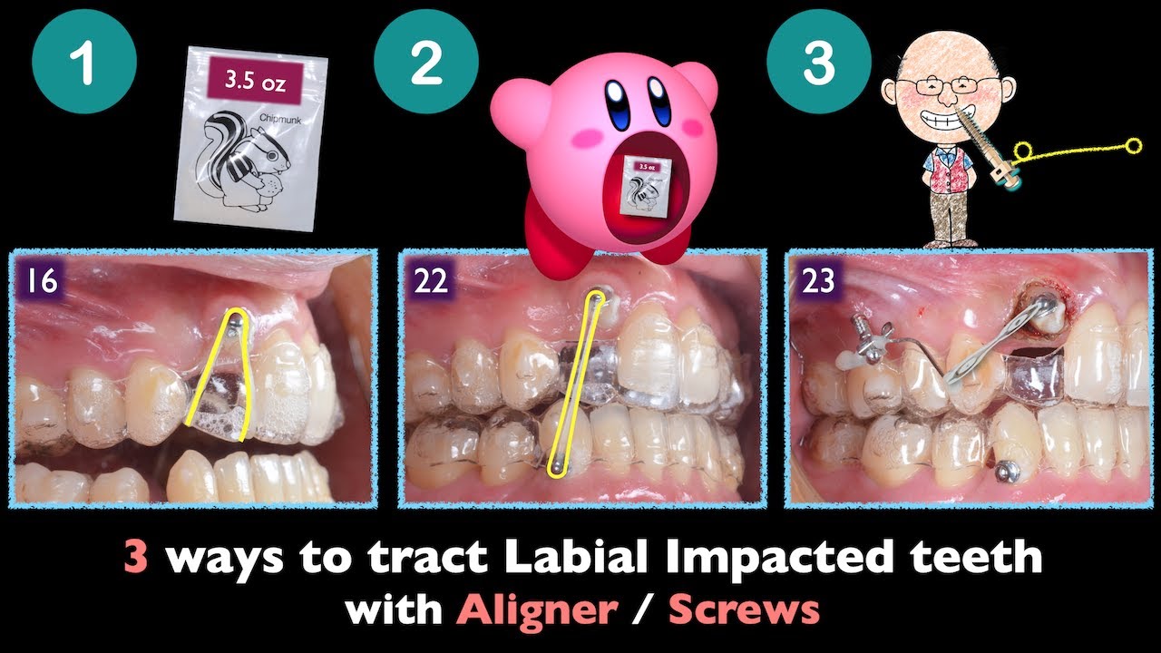 3 Ways To Tract Impacted Teeth With Aligners Screws Chris Chang 3-ways-to-tract-impacted-teeth-with-aligners-screws-chris-chang