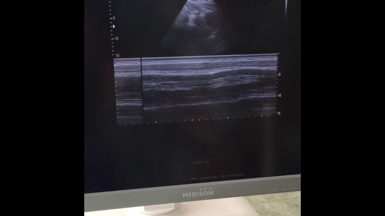 Echographe ACCUVIX XG SAMSUNG MEDISON - YouTube