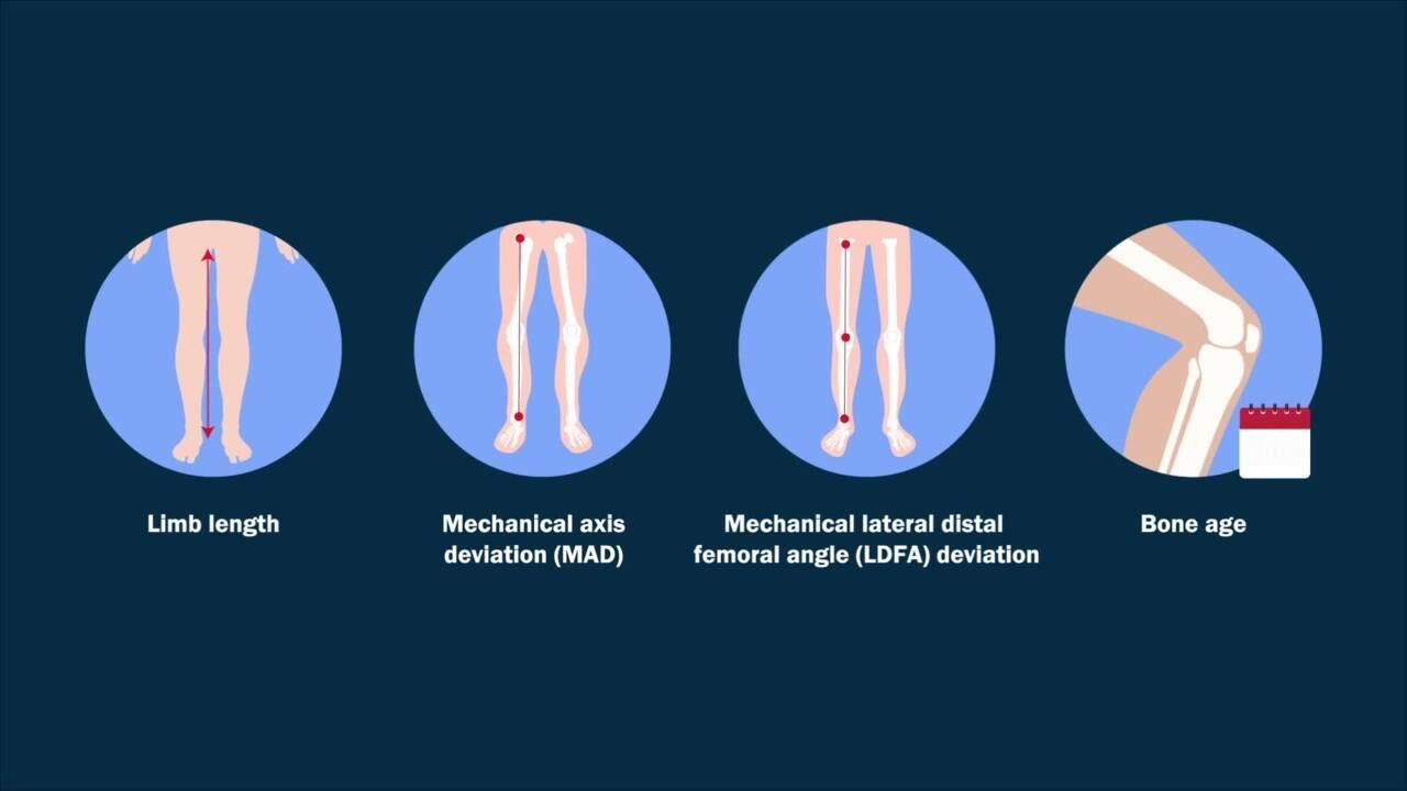 Faster Correction Rate with Distal Femoral Transphyseal Screws Versus ...