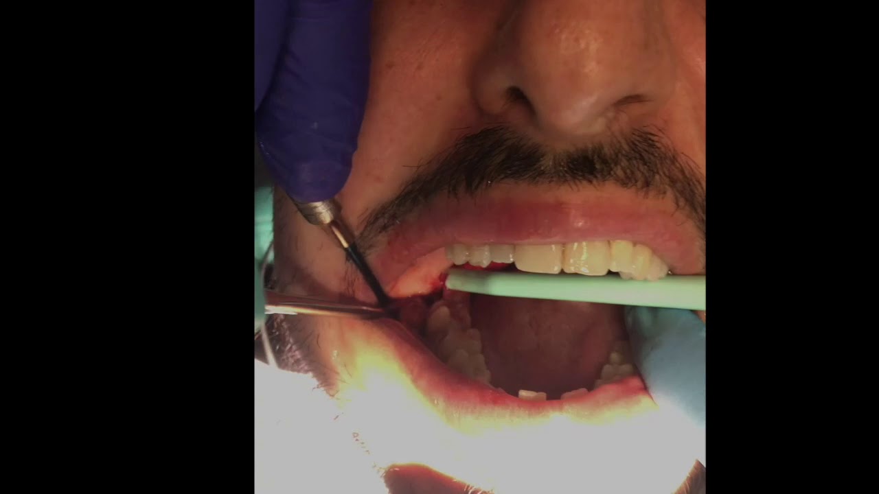 Horizonal full bony impacted #32 - YouTube