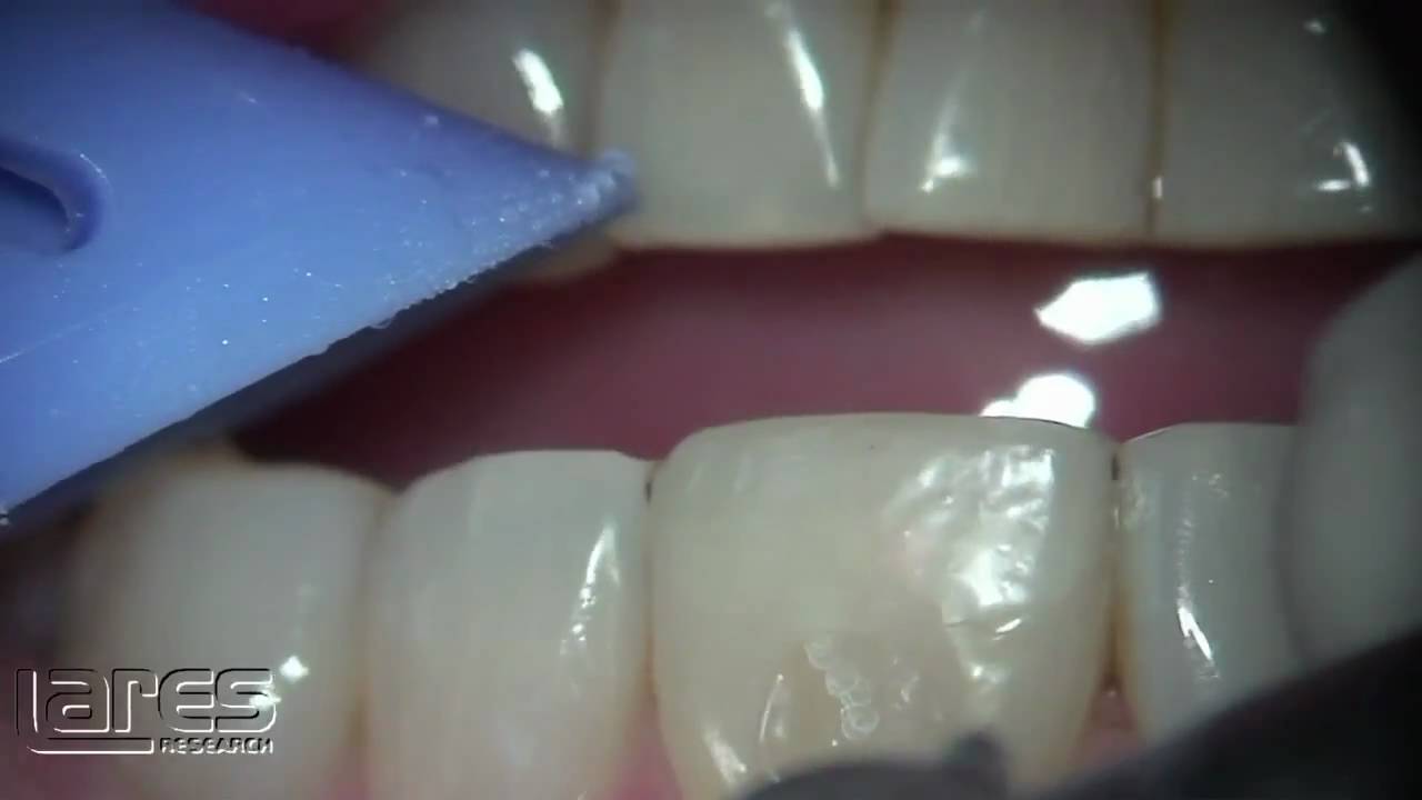 Laser Dentistry: Veneer Removal - Lares PowerLase AT - YouTube