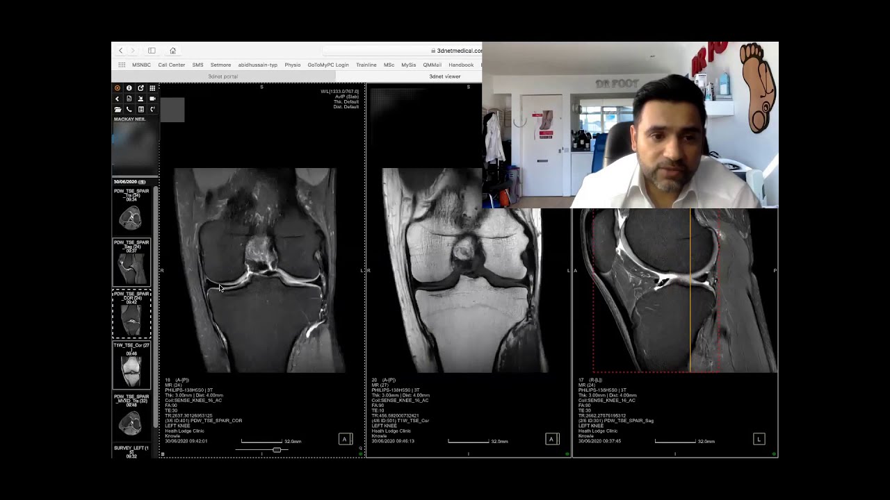 MRI Knee pre Ostenil Knee Injection for Meniscus Tear - YouTube