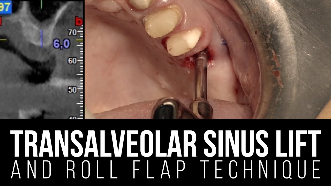 Roll Flap Technique & Transalveolar Sinus Elevation - YouTube
