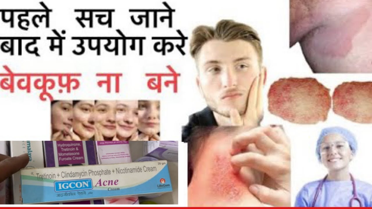 Igcon acne cream best review in hindi पिम्पल्स के निशान, दाग धब्बे ...