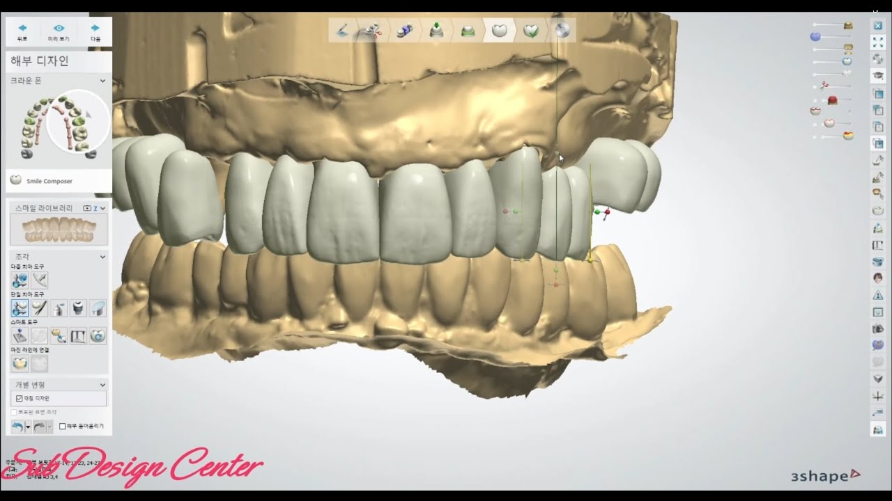 3shape design full arch case (implant case, upper)// 상악 풀아치 디자인 - YouTube