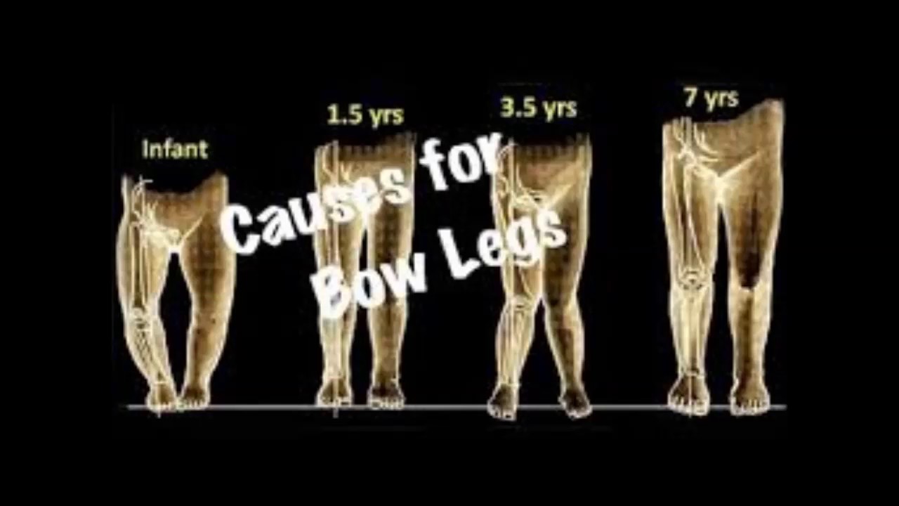 Knocked Knees, Bow Legs Correction& Knock Kneed Sally - YouTube