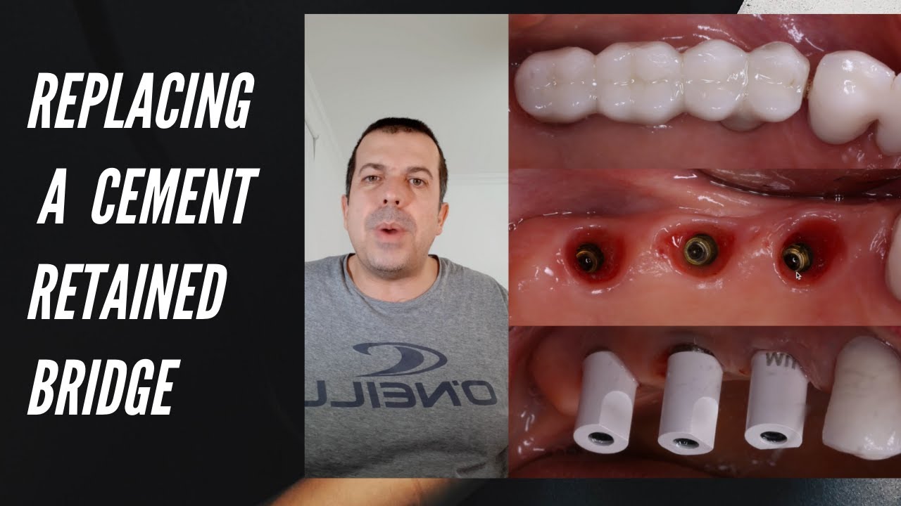 Replacing Cement Retained Failing Bridge - Brighton Implant Clinic ...