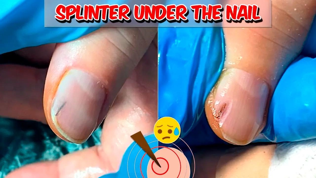 How to Remove a Splinter from Under Your Nail: Getting Out a Big One ...