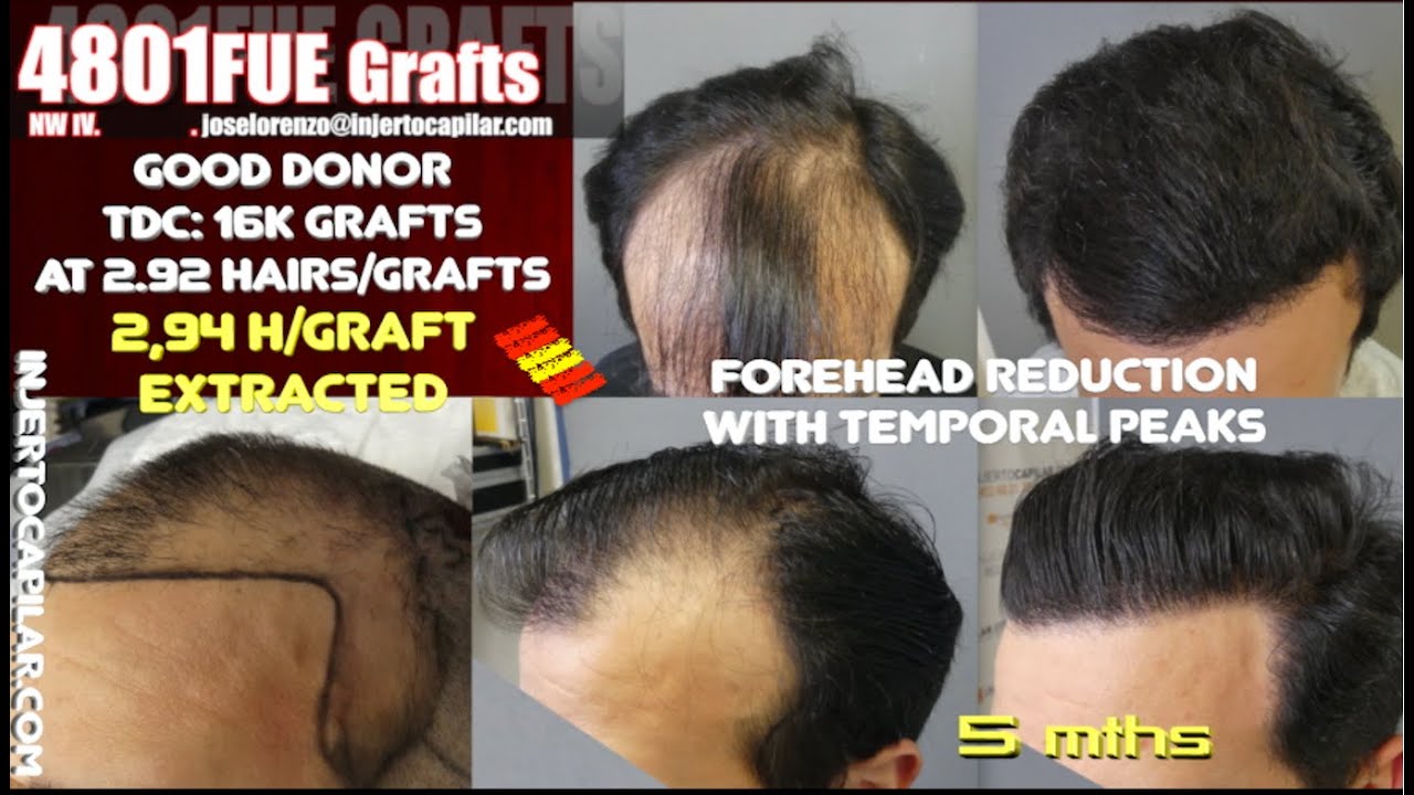 4801Grafts. NW IV.Forehead reduction with temporal peaks. 2,94h/g ...