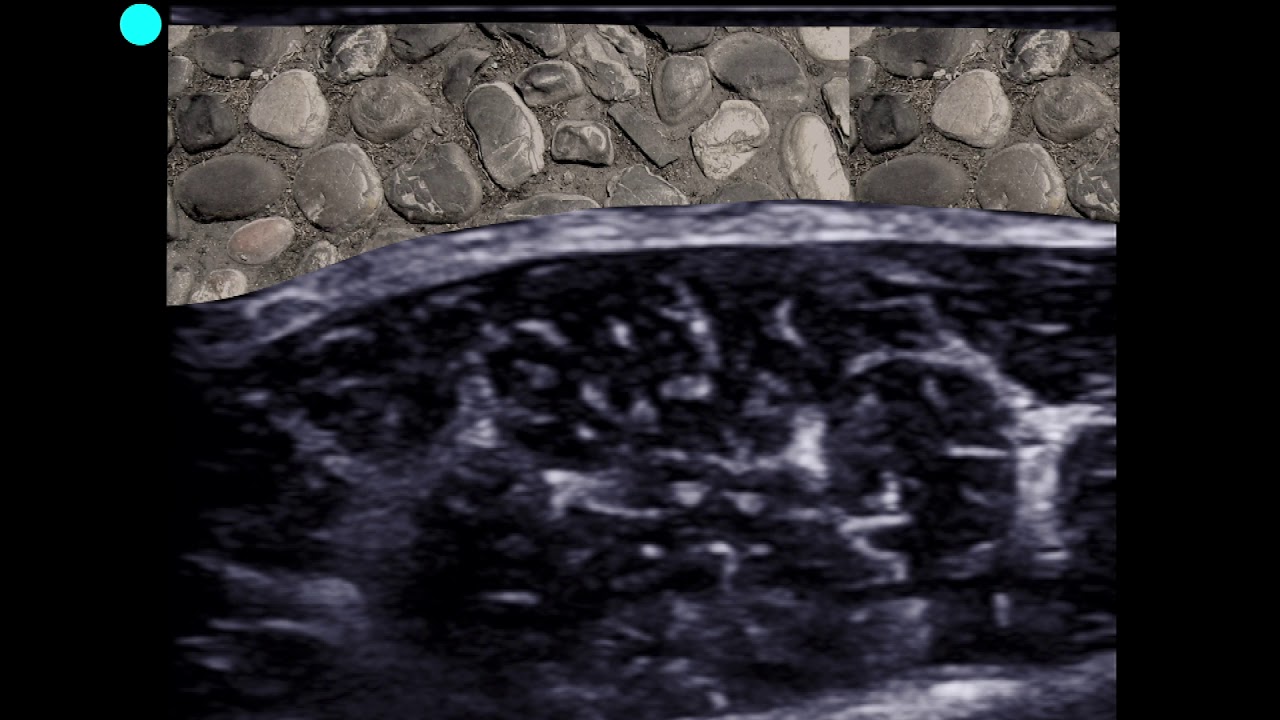 POCUS - Soft Tissue Ultrasound - Cobblestoning - YouTube