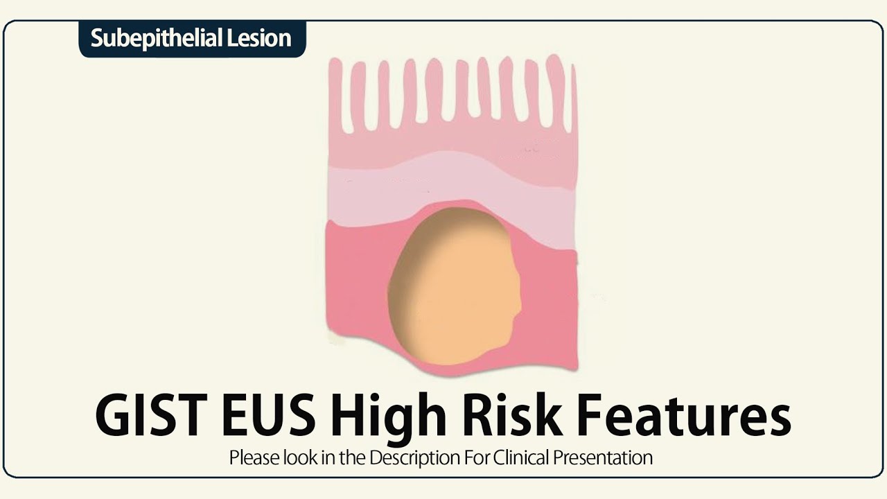 GIST EUS High Risk Features - YouTube