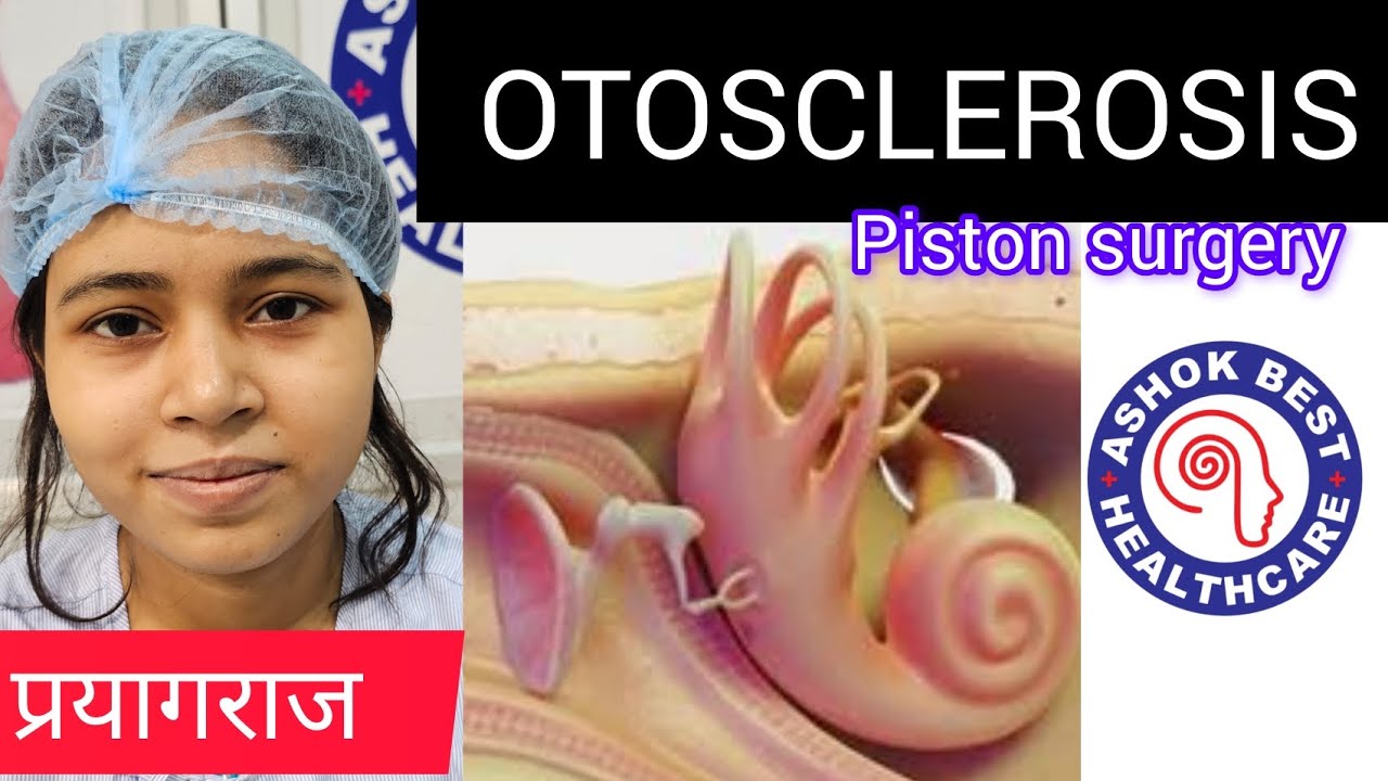 HEARING AFTER PISTON SURGERY FOR OTOSCLEROSIS प्रयागराज की युवती को ...