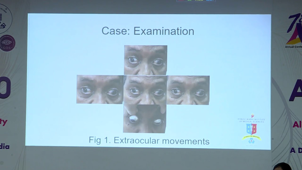 AIOC2020 HydePark II Dr P Rajarajeswary WEBINO SYNDROME An interesting ...