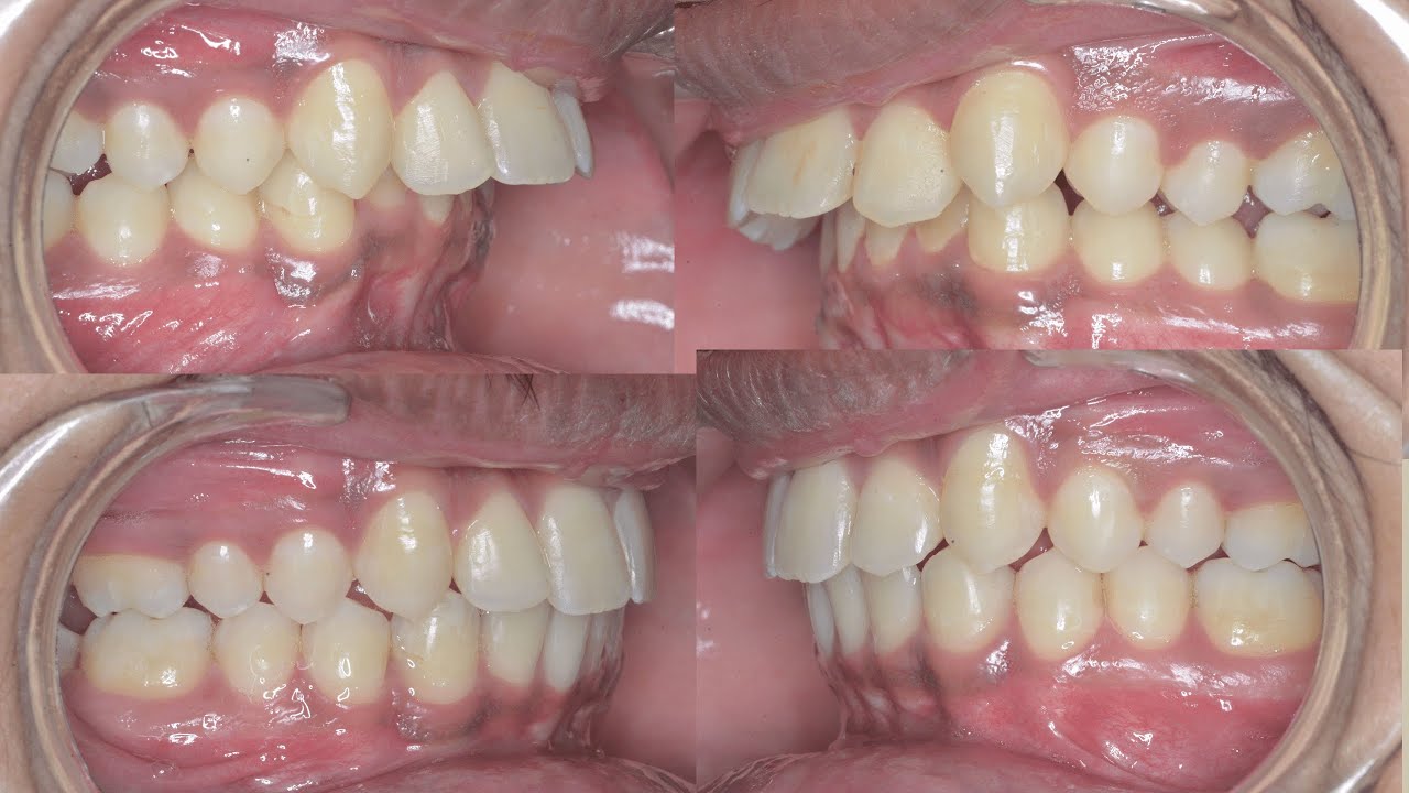 OVERBITE TEETH AND BUCK TEETH CORRECTION ADULT BRACES BRACES BEFORE