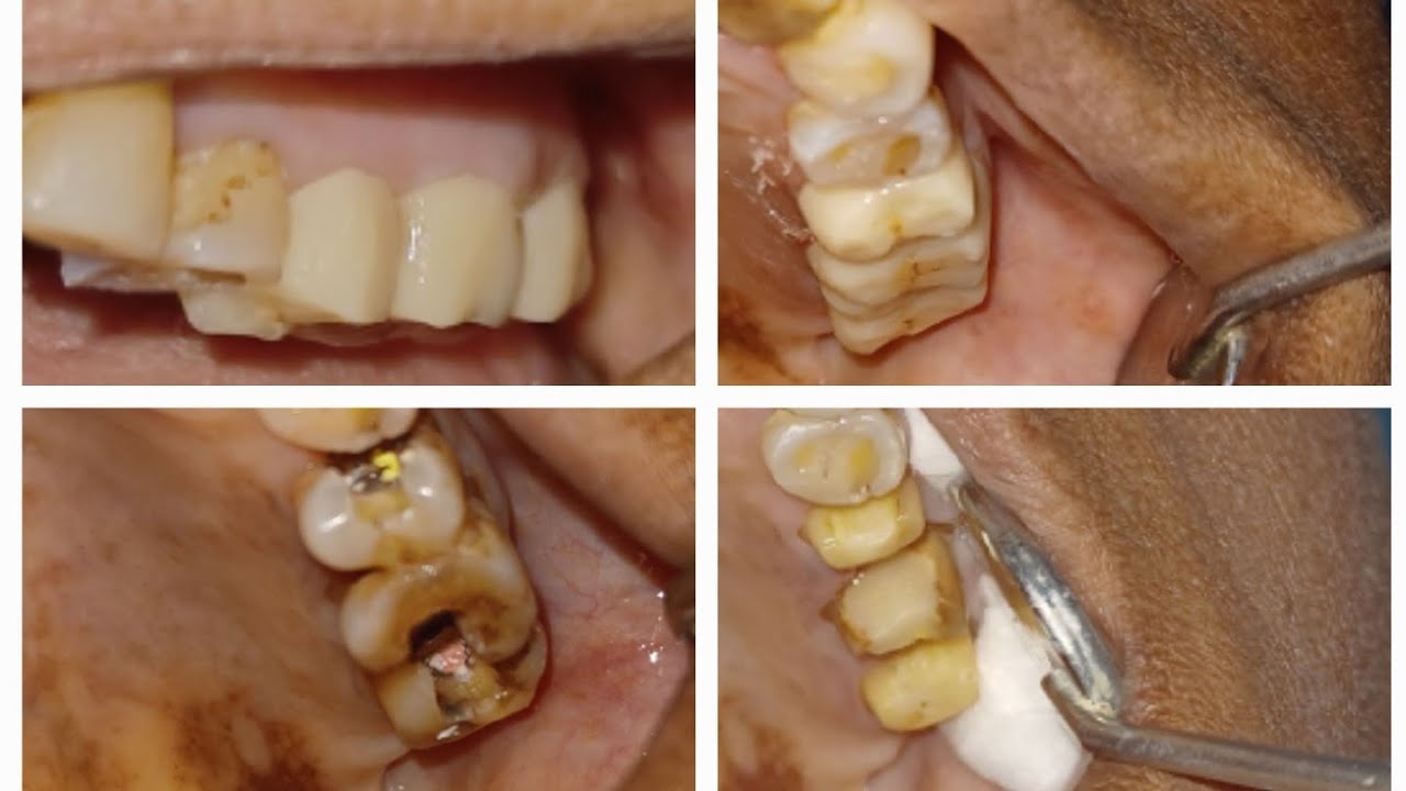 RCT (root canal treatment)w.r.t 24, 25, & 26. followed by zirconia ...