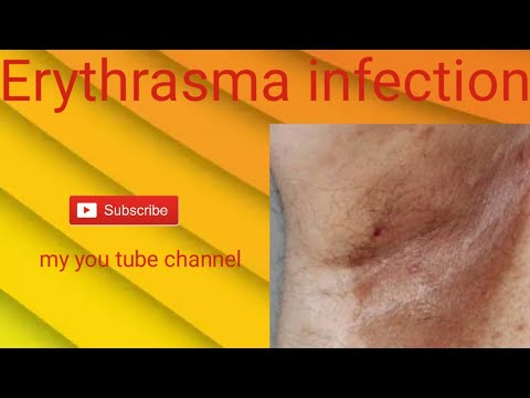 Skin infection (Erythrasma) - YouTube