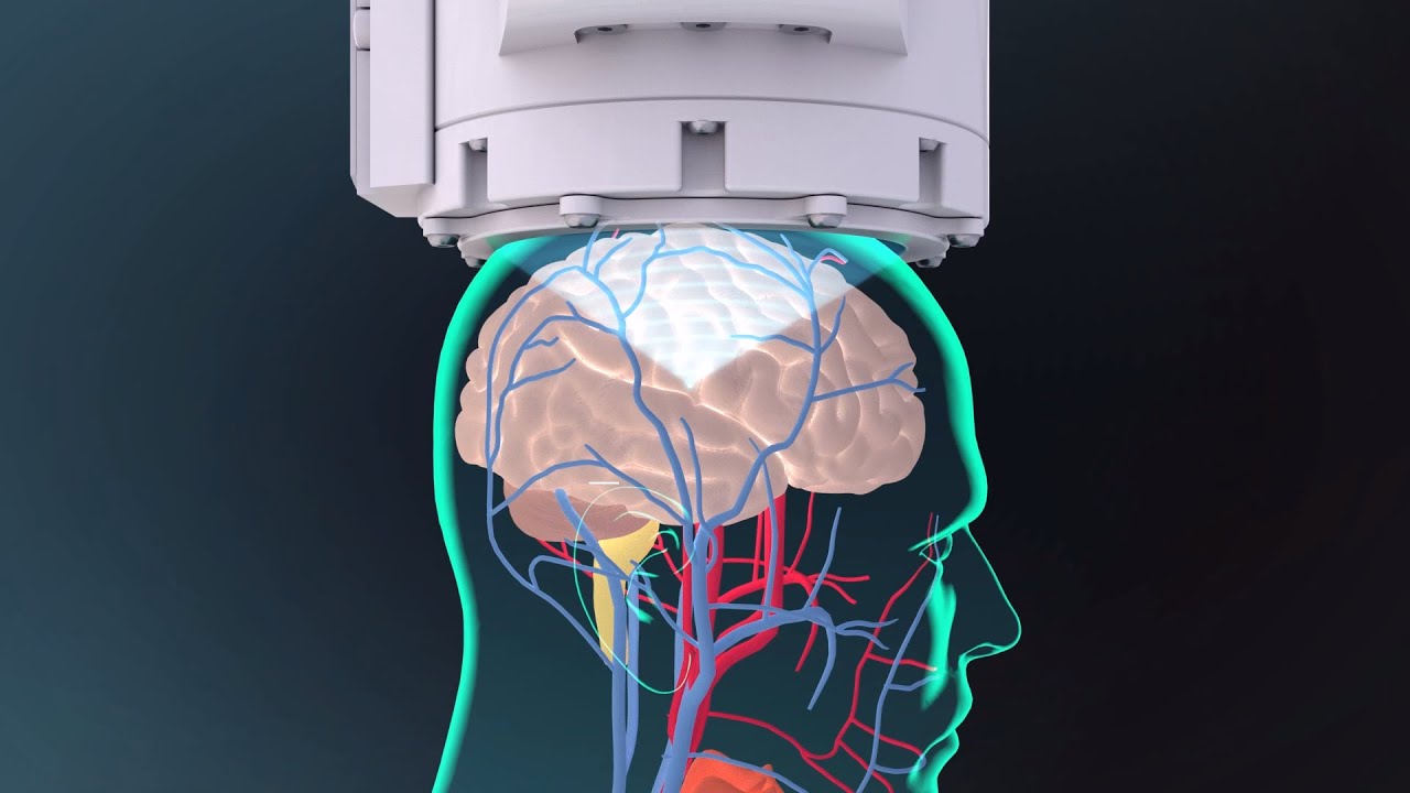 NaviFUS system-產品介紹 - YouTube