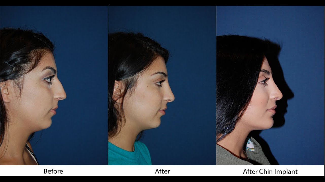 Rhinoplasty- Patient of the week, with Charlotte's top nose job surgeon ...