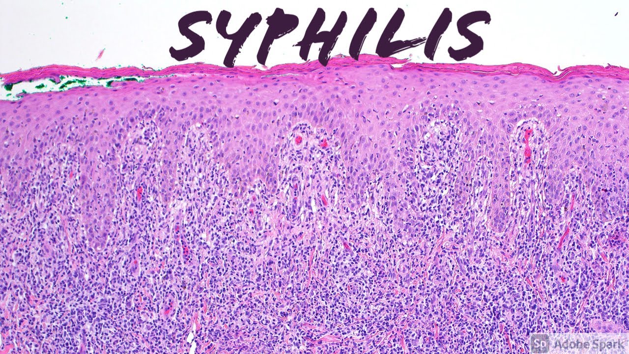 Secondary Syphilis (Lues): 5-Minute Pathology Pearls - YouTube