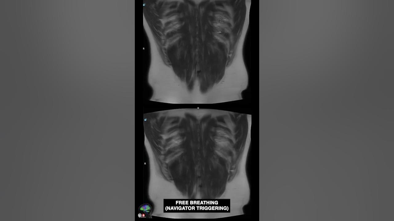 OPTIMISING HASTE SEQUENCE MRI YouTube optimising-haste-sequence-mri-youtube