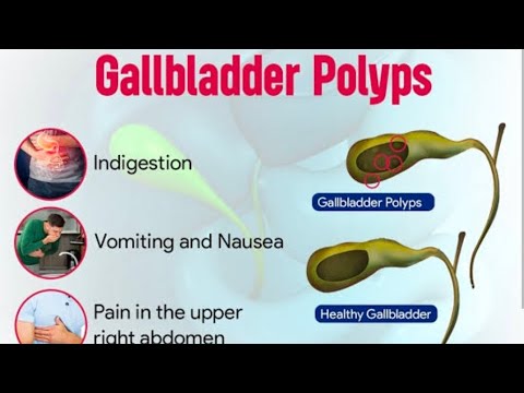 Gallbladder Polyp treatment - YouTube