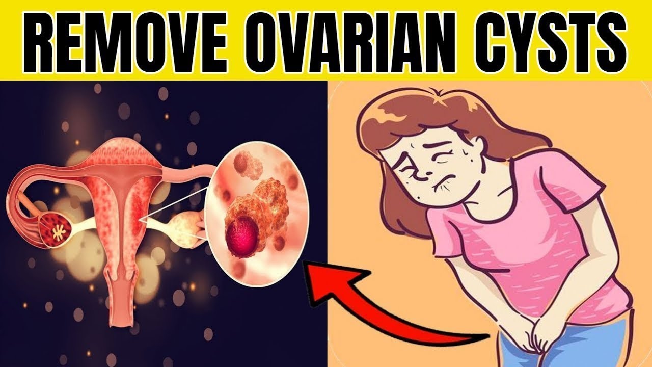 How To Get Rid of Ovarian Cysts Naturally - YouTube