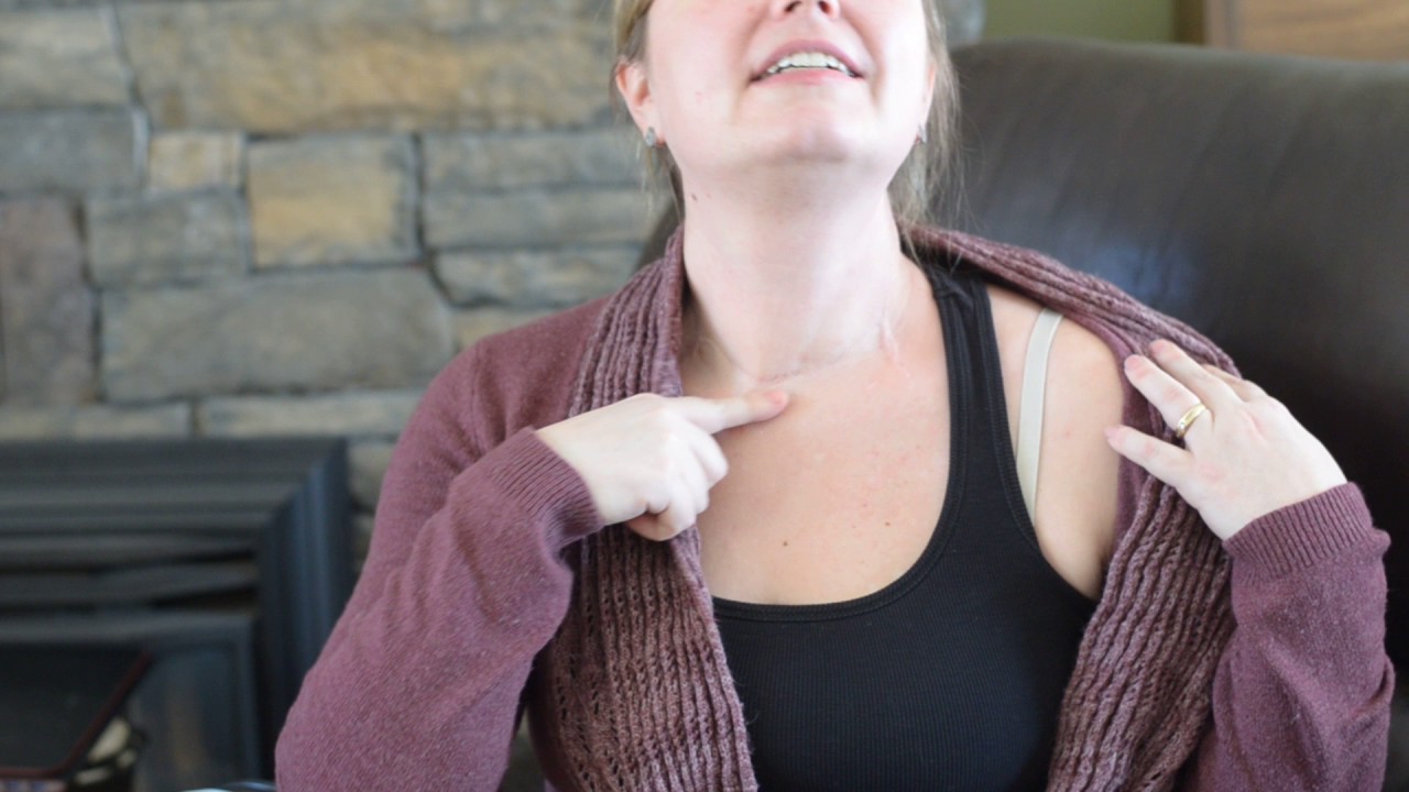 Allison Kooijman shows the scar from her bilateral neck dissection ...