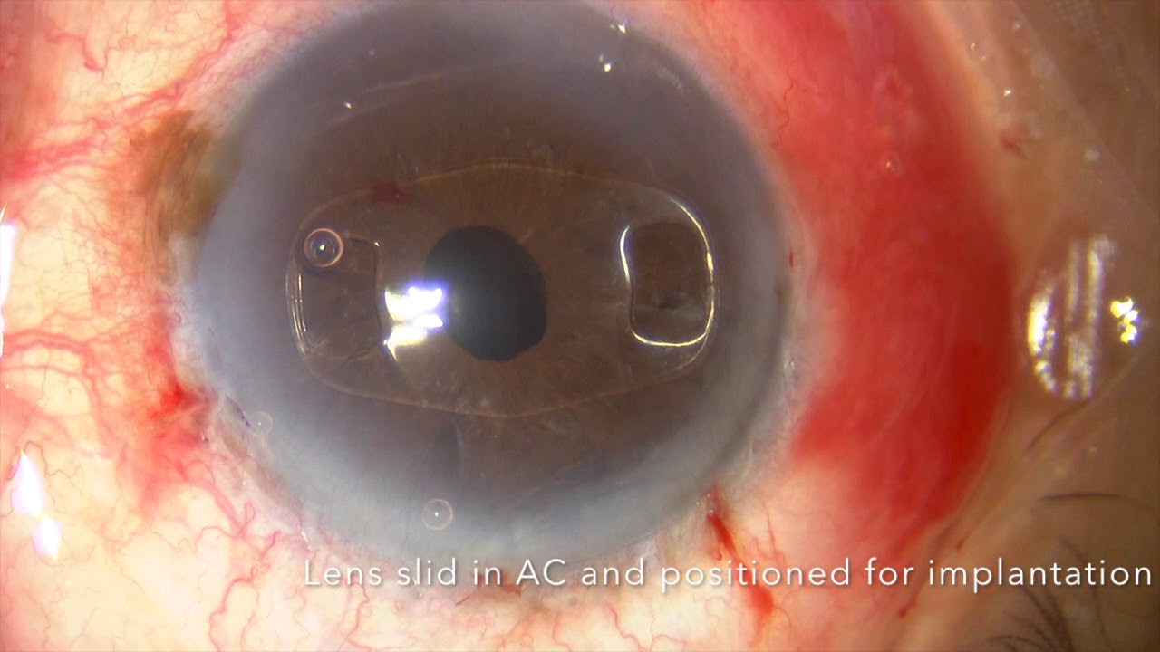 Retro-Pupillary Iris Claw (Artisan) Lens Implantation Technique - YouTube